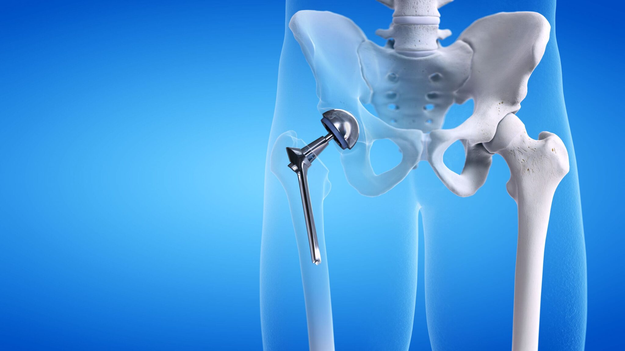 advantages-of-getting-total-hip-replacement