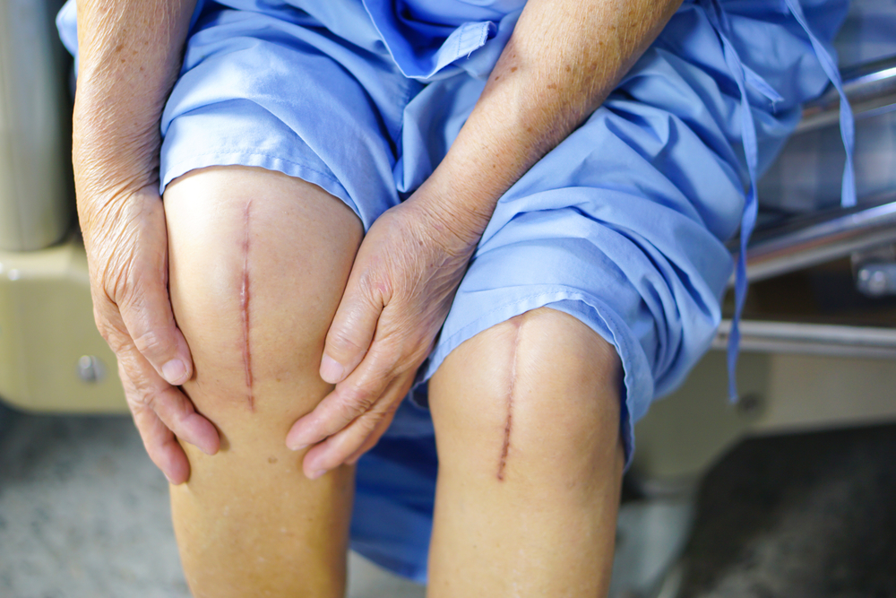 Top 5 Mistakes After Knee Replacement Surgery Hip Knee Orthopaedics Top 5 Mistakes After Knee Replacement Surgery Hip Knee Orthopaedics