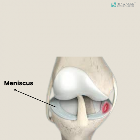 Can You Replace Your Meniscus? - Treatment Guide
