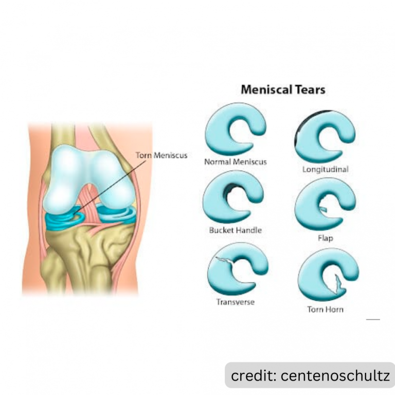 Meniscus Tear Treatment & Surgery | Hip & Knee Orthopaedics